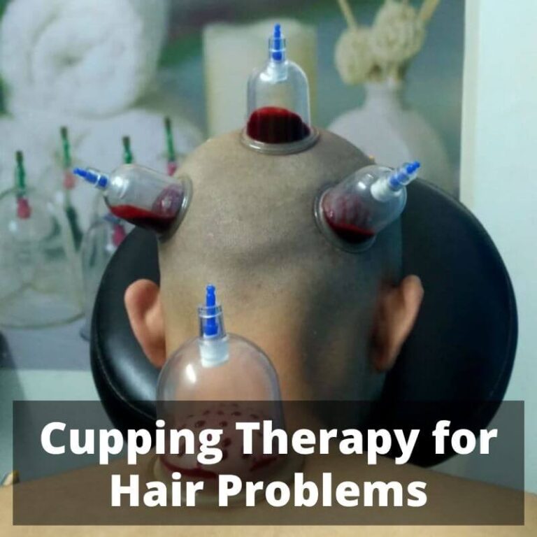 Cupping Therapy for Hair Problems - PRP Treatment center