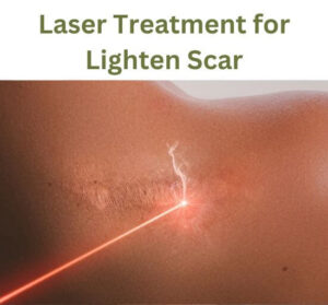 Laser Treatment for Lighten Scar - PRP Treatment center